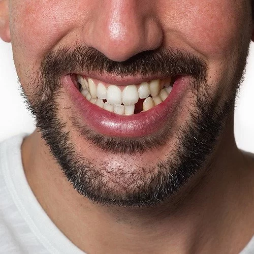 Effects of missing teeth - Implant Dental Clinic